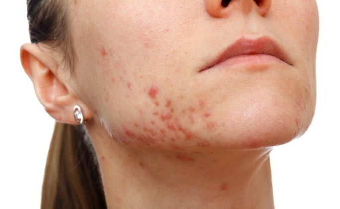 Mengenal 7 Jenis-jenis Jerawat dan Cara Mengatasinya dengan Tepat