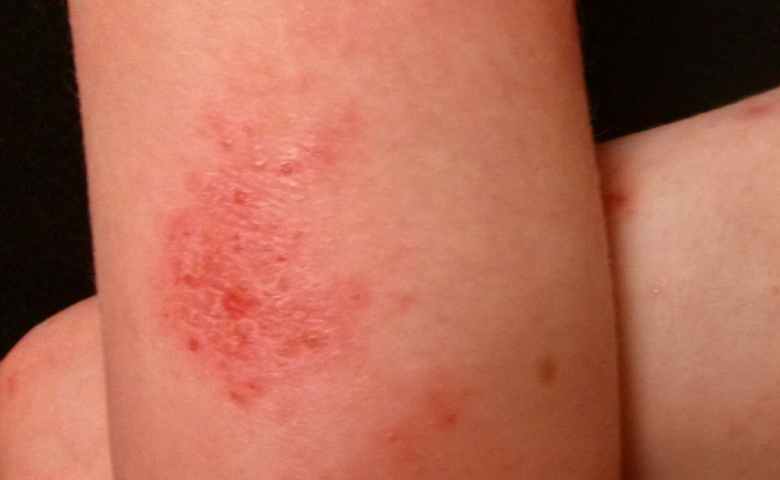 Bahaya Kecoak Bagi Kesehatan dan Cara Mudah Mengusirnya