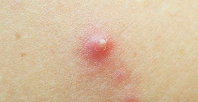 10 Penyebab Bisul: Makanan Tak Sehat hingga Imun Lemah