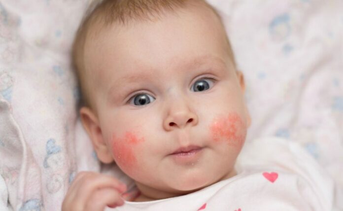 Penyebab Bintik Merah pada Bayi dan Cara Menghilangkannya