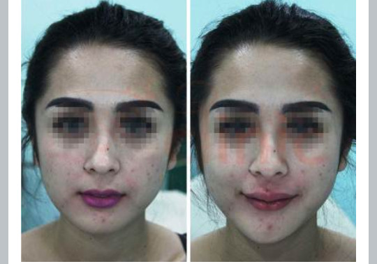 Jual FILLER HIDUNG, BIBIR DAN DAGU - Kab. Bondowoso - MeizaNES | Tokopedia